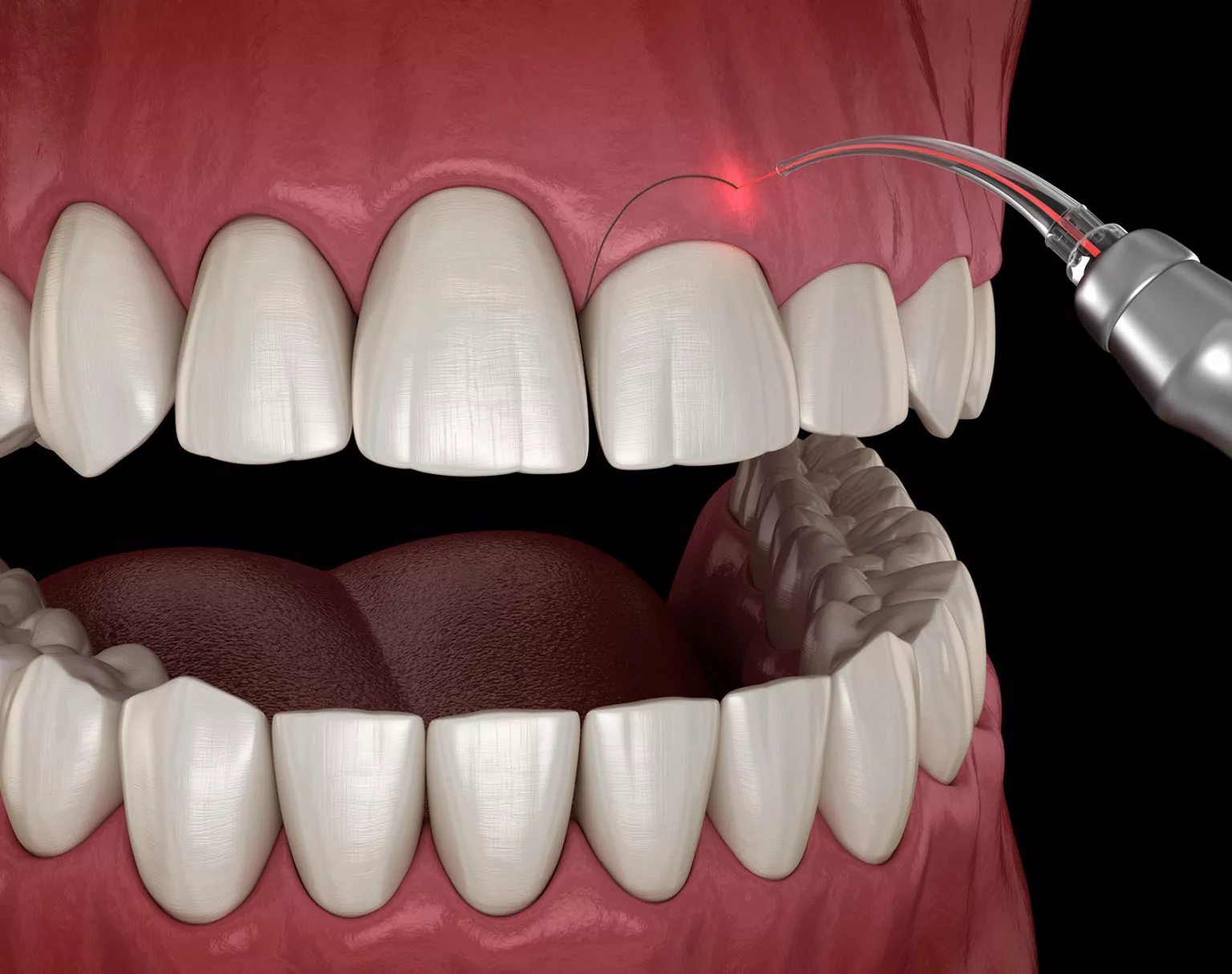 Periodontal Plastic Surgery - Springfield, MO - Dr. Tokarczyk